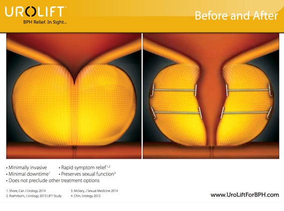 UroLift®